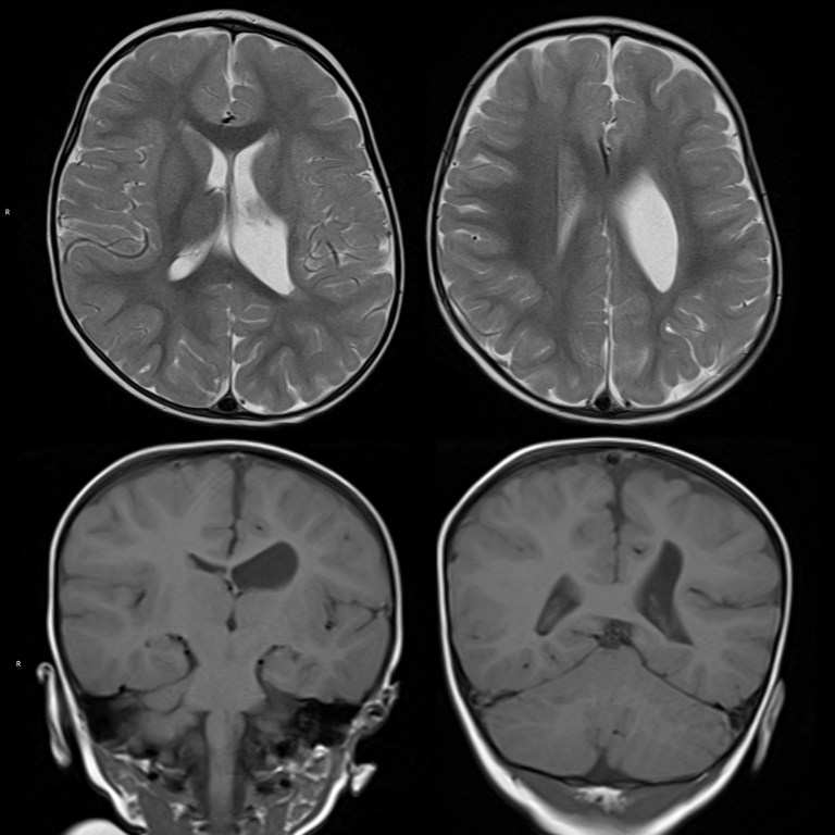 Pediatric Acute Ischemic Stroke | Pediatric Radiology Reference Article ...