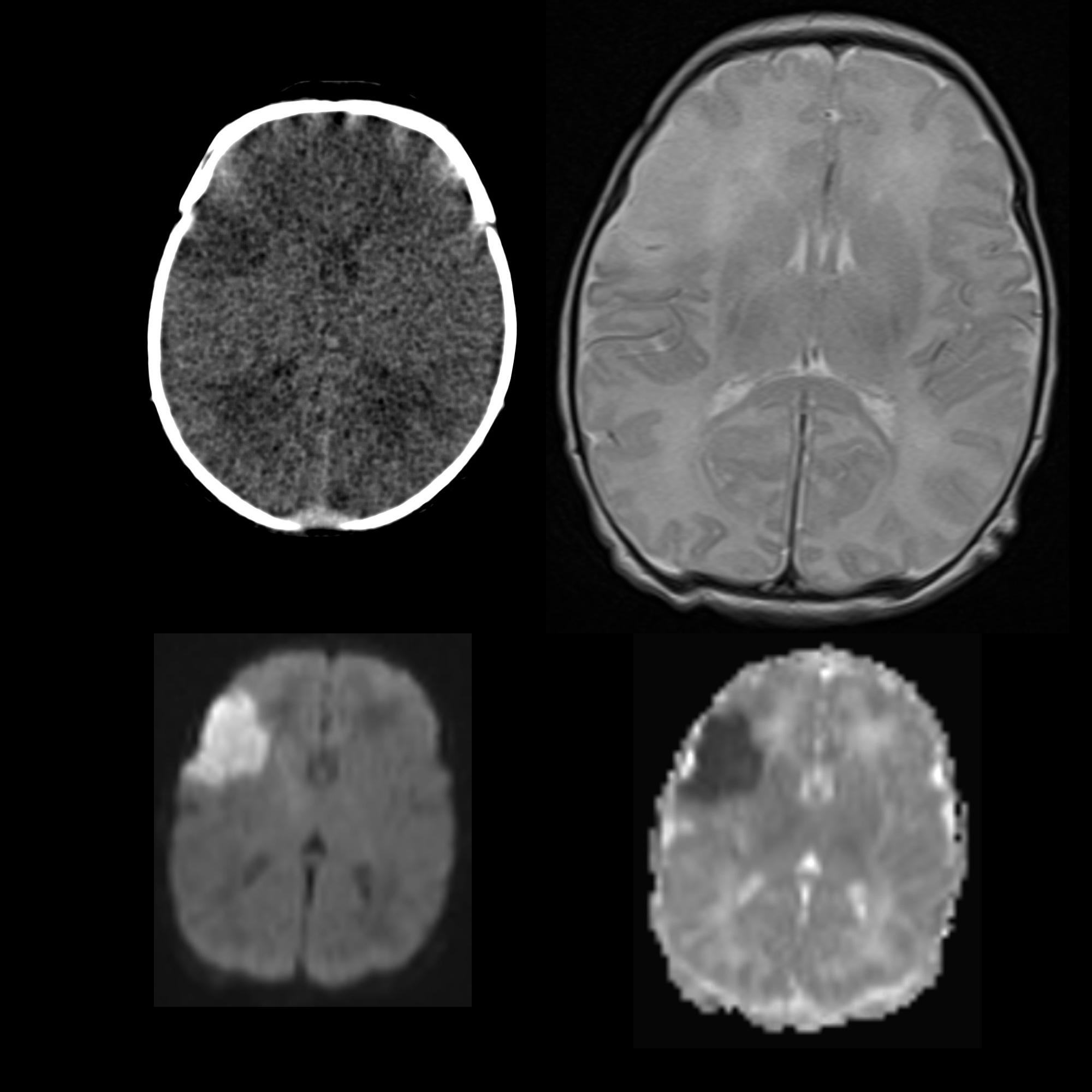 Pediatric Acute Ischemic Stroke | Pediatric Radiology Reference Article ...