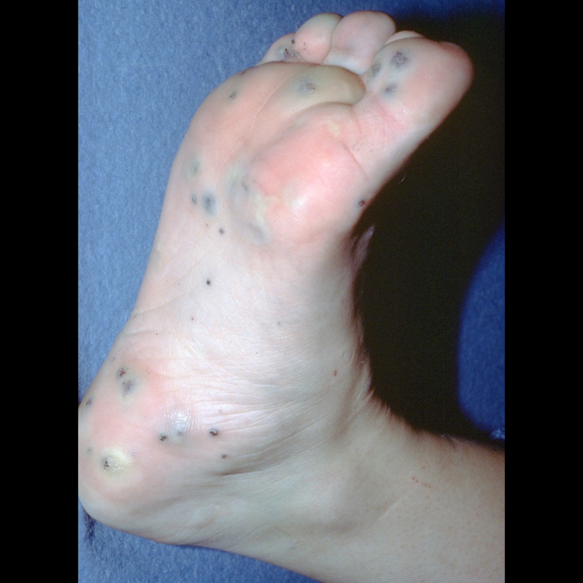 Teenager with black-blue subcutaneous nodules and chronic GI bleeding ...