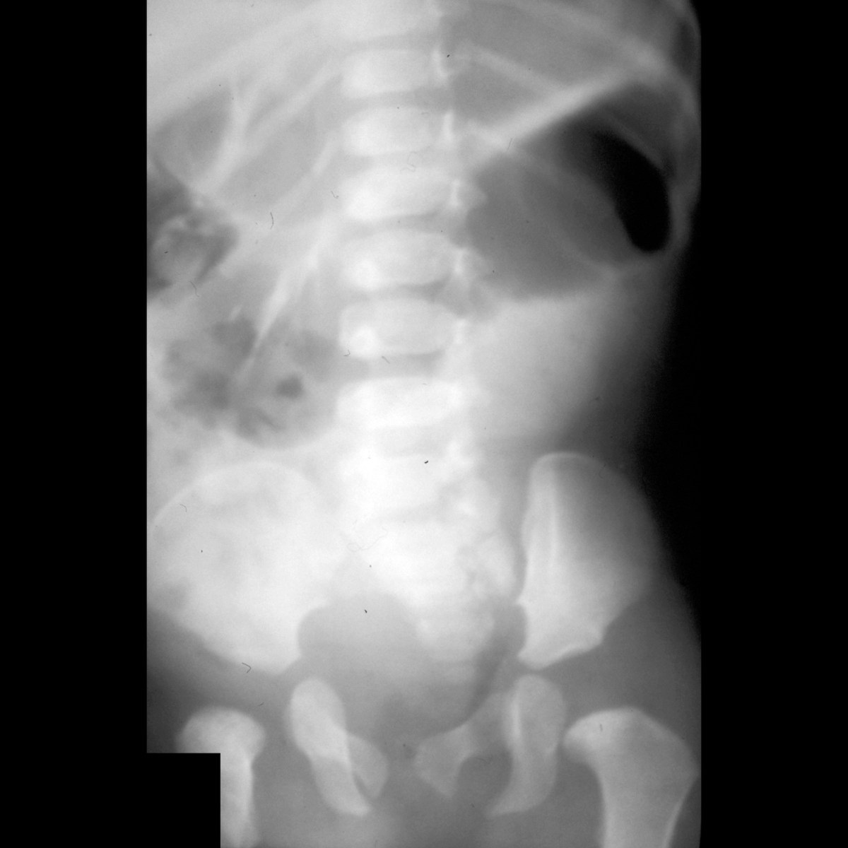 Preschooler with short stature | Pediatric Radiology Case | Pediatric ...