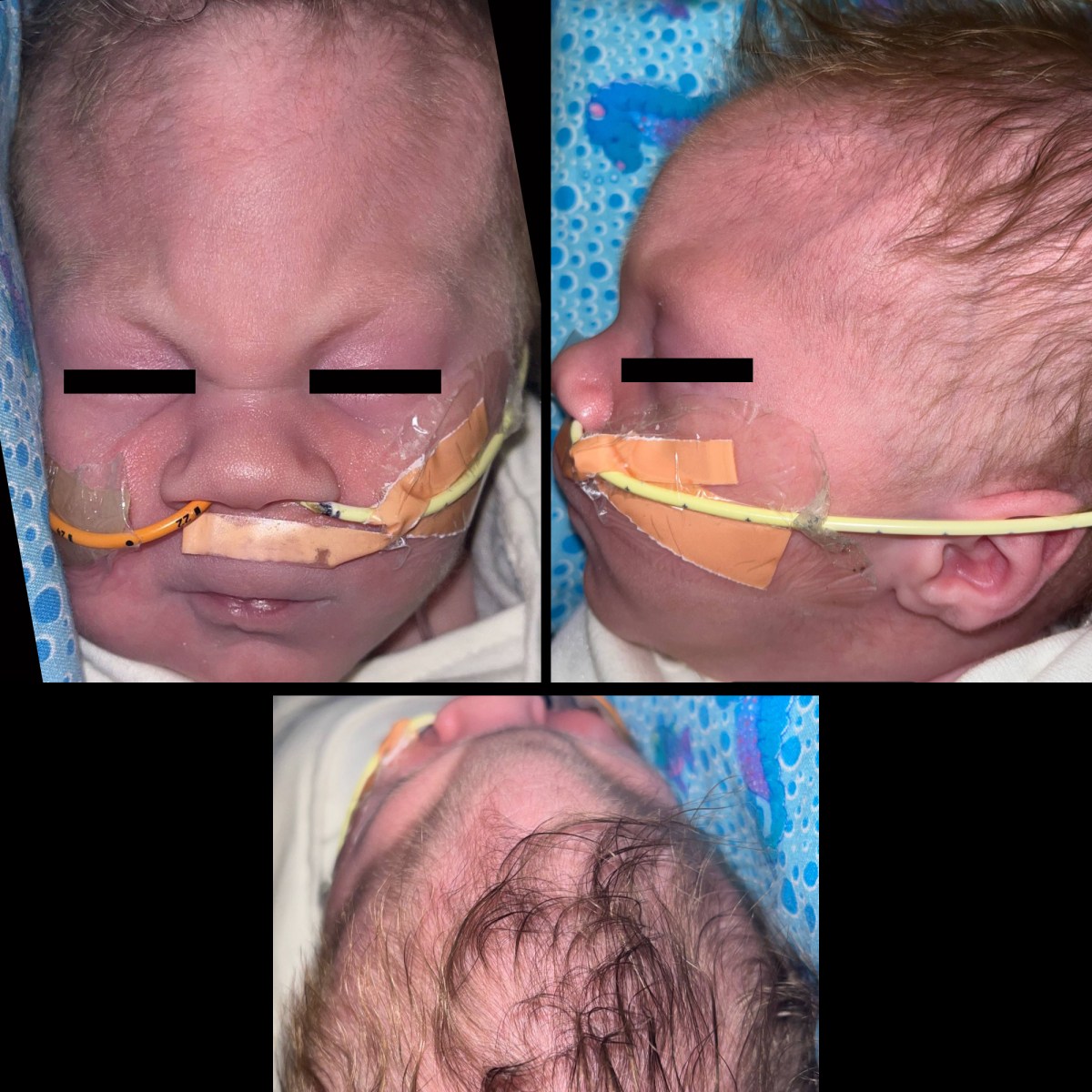 Infant with a ridge on their forehead | Pediatric Radiology Case ...