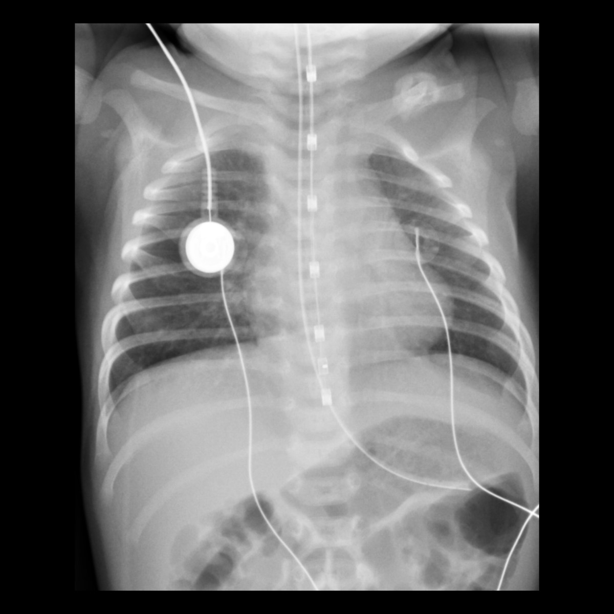 1 month old with gastroesophageal reflux | Pediatric Radiology Case ...