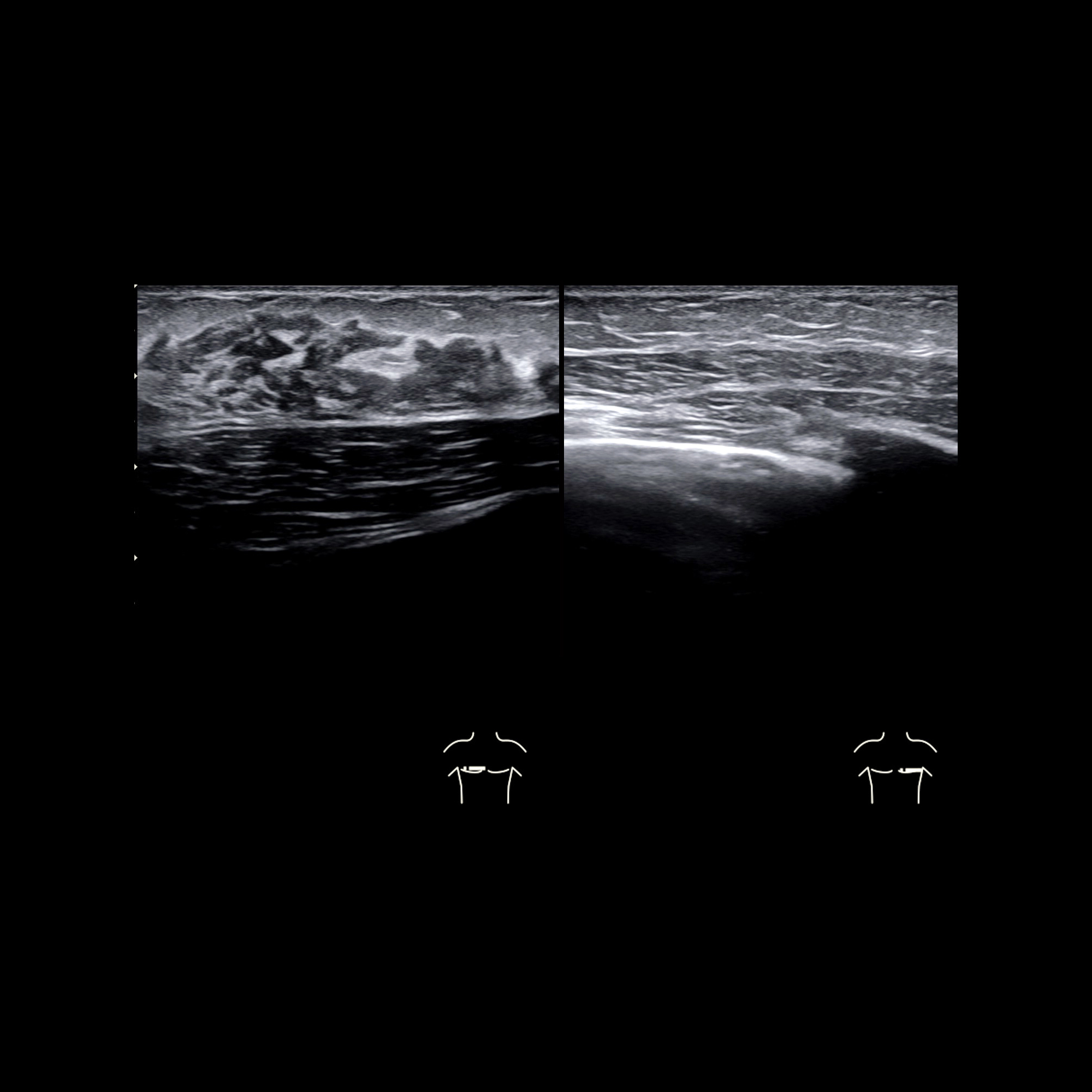 Pediatric Gynecomastia | Pediatric Radiology Reference Article ...