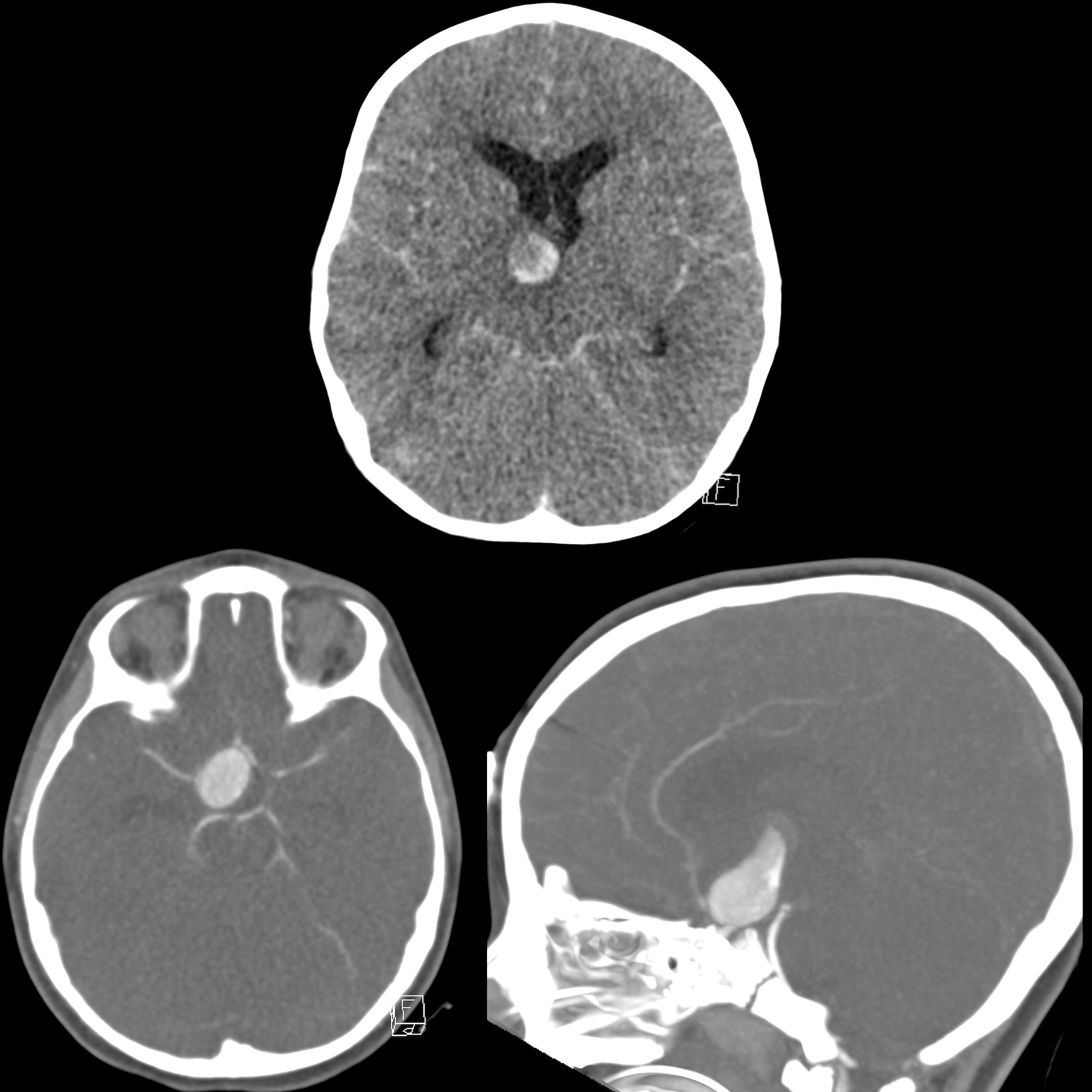 Pediatric Intracranial Aneurysm | Pediatric Radiology Reference Article ...