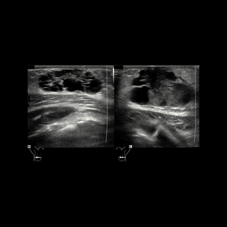 Pediatric Mastitis | Pediatric Radiology Reference Article | Pediatric ...