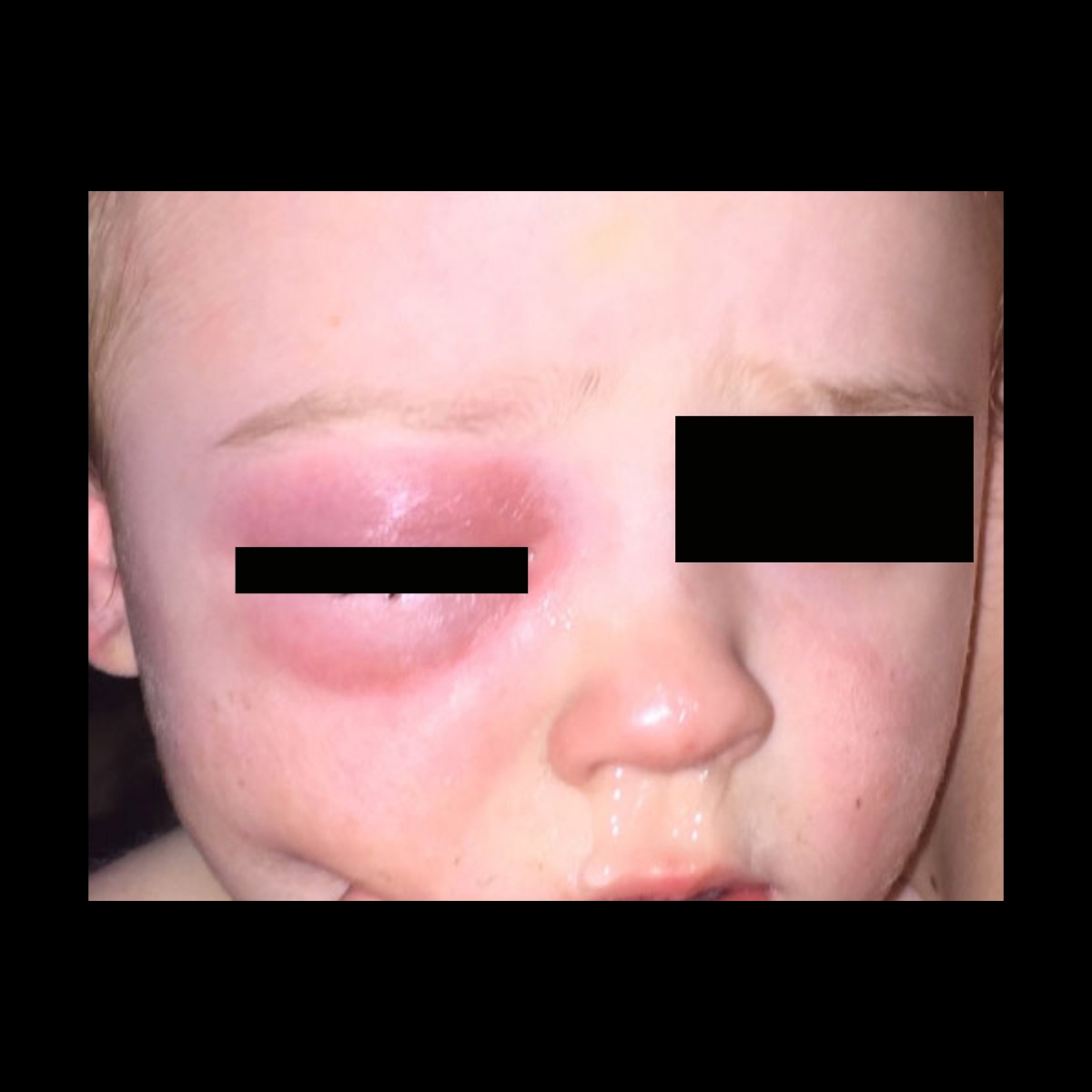 Toddler with a swollen right orbit | Pediatric Radiology Case ...
