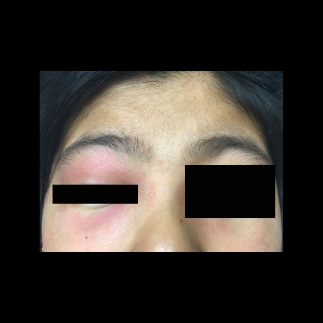Pediatric Orbital Cellulitis | Pediatric Radiology Reference Article ...
