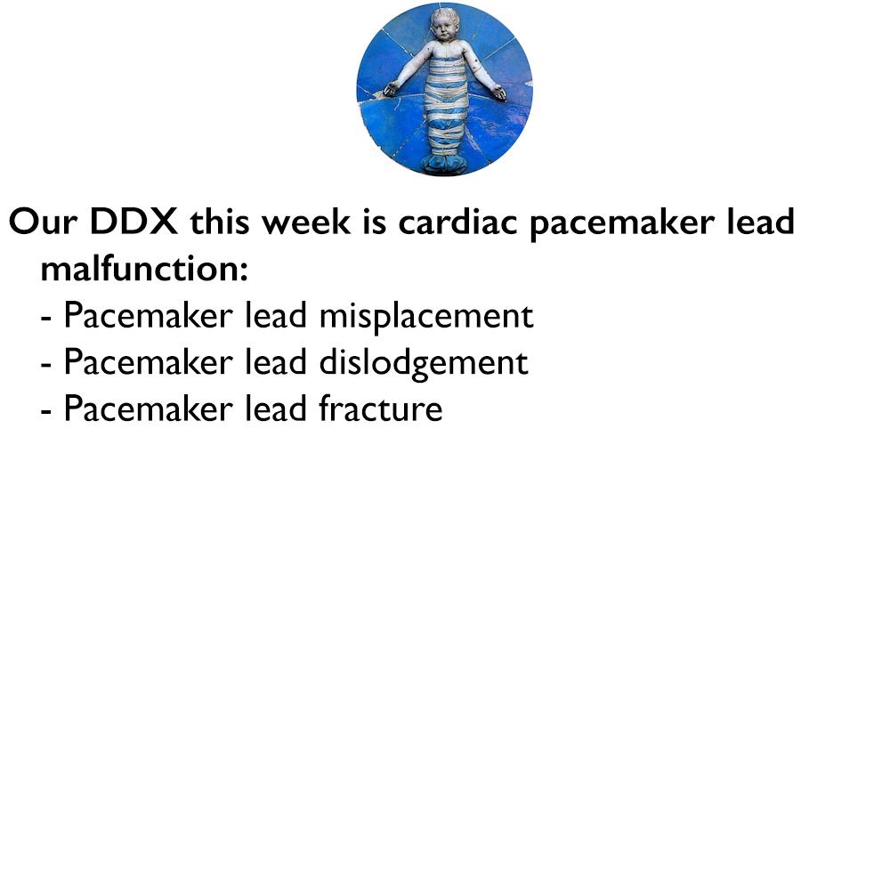 PIDDXCardiacPacemakerMalfunction | Pediatric Radiology Case | Pediatric ...