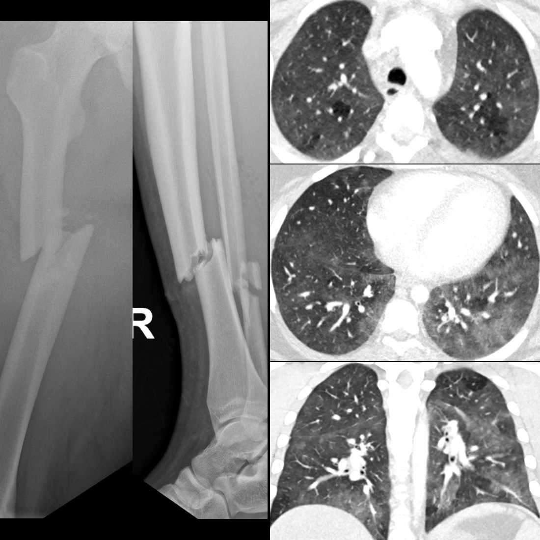 Pediatric Pulmonary Fat Embolism | Pediatric Radiology Reference ...