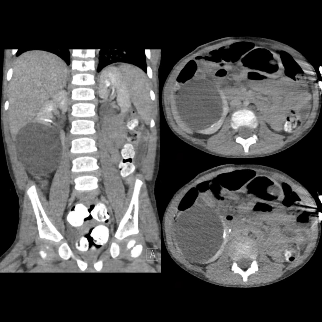 Pediatric Renal Cyst | Pediatric Radiology Reference Article ...