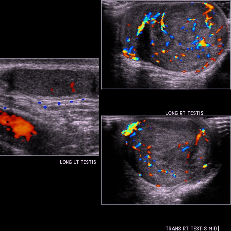 Pediatric Paratesticular Rhabdomyosarcoma | Pediatric Radiology ...