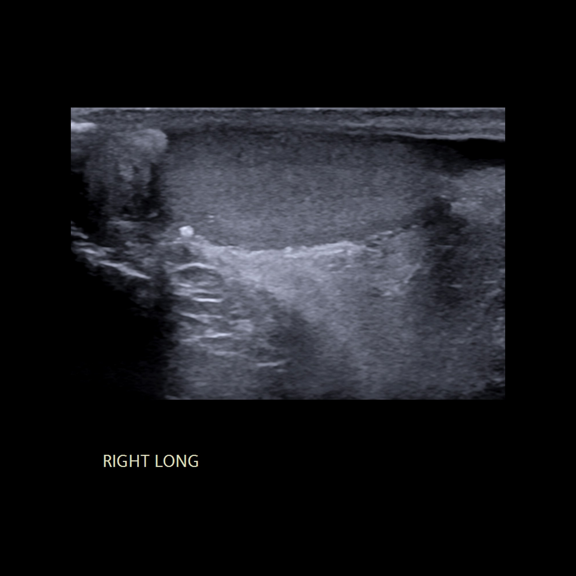 Pediatric Scrotolith | Pediatric Radiology Reference Article ...