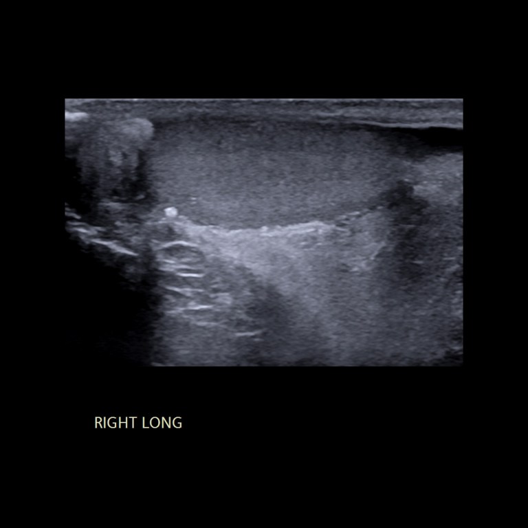 pediatric-scrotolith-pediatric-radiology-reference-article