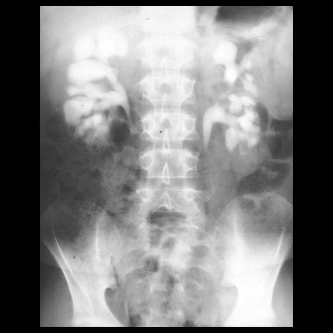 Pediatric Congenital Megacalyces | Pediatric Radiology Reference Article | Pediatric Imaging ...