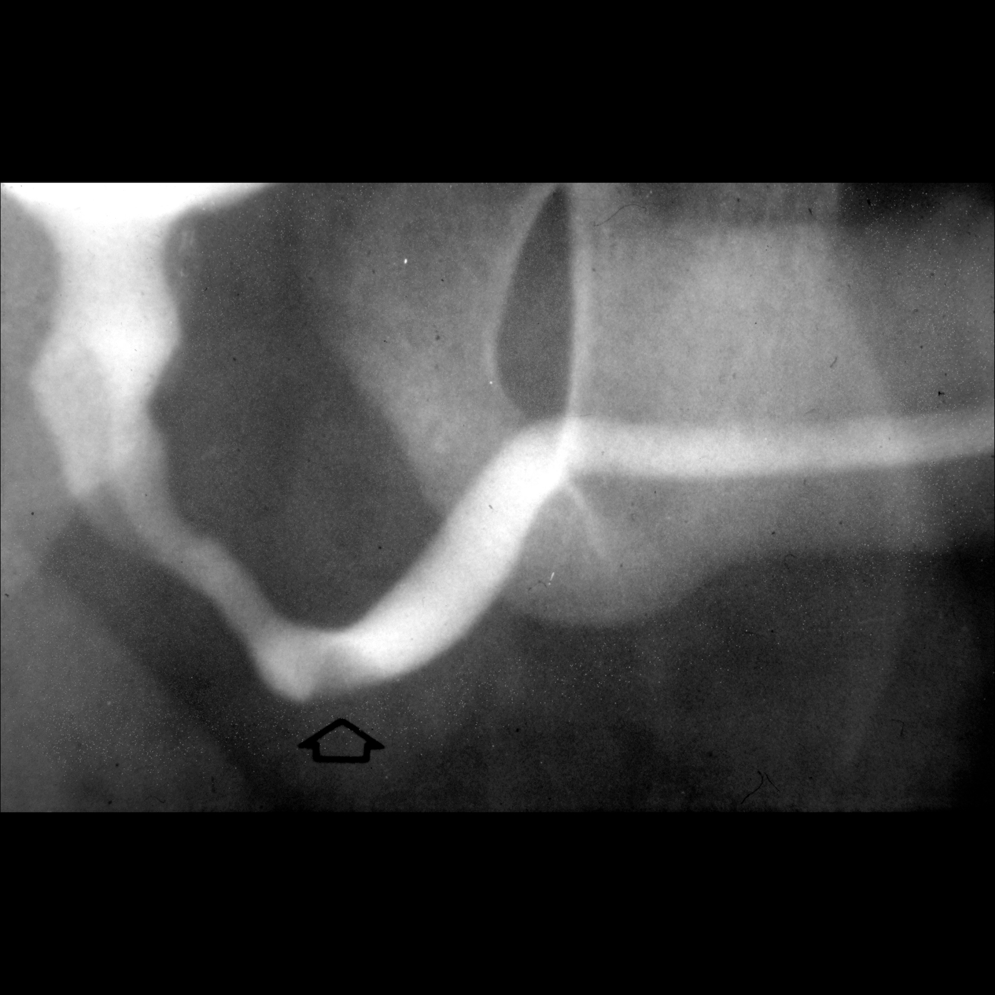 Pediatric Cowper Duct Syringocele | Pediatric Radiology Reference ...