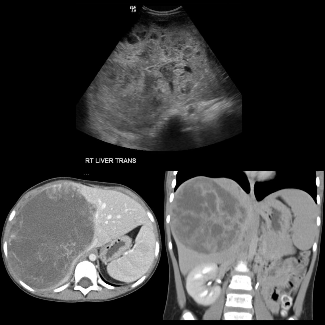 Undifferentiated Embryonal Sarcoma of the Liver | Pediatric Radiology ...