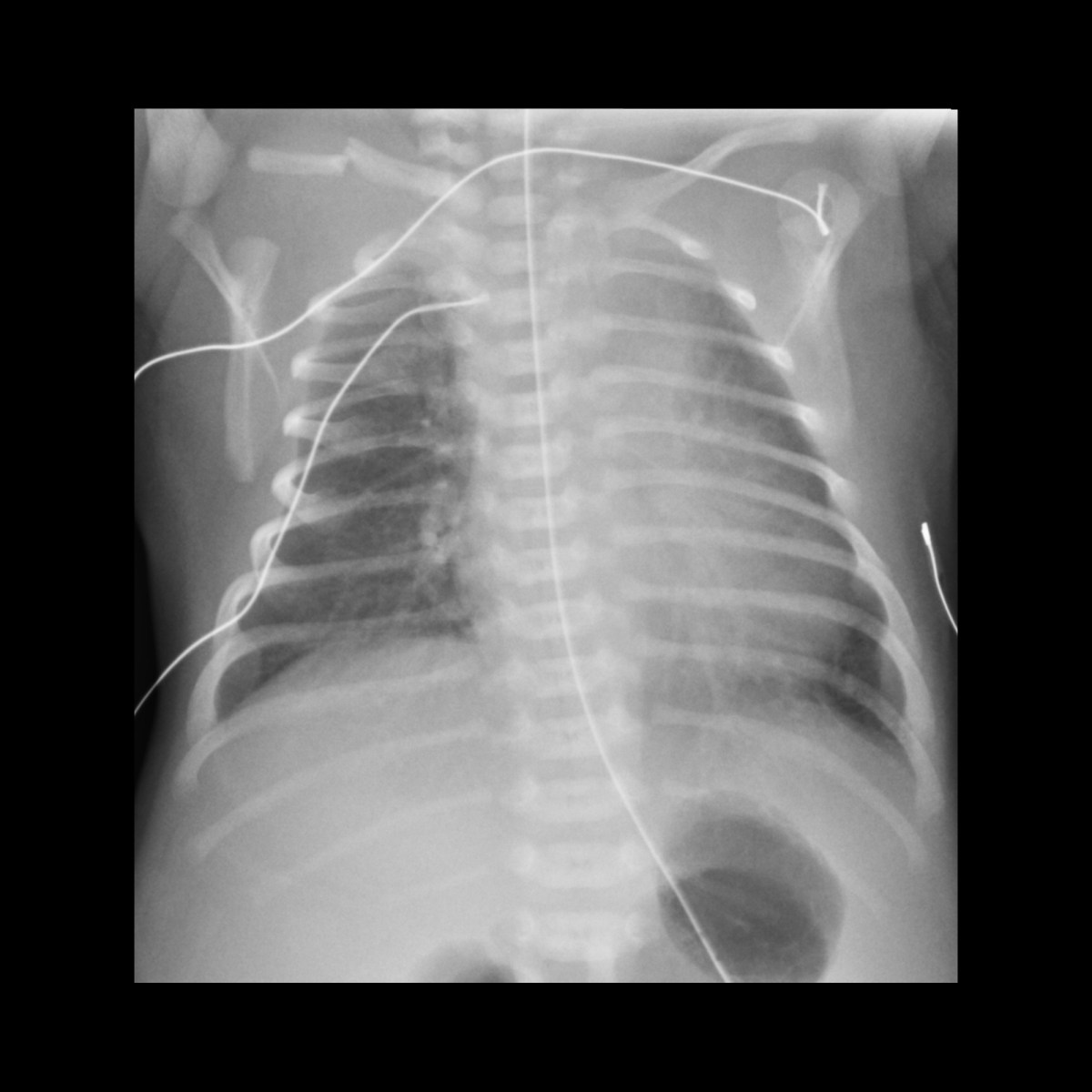 Newborn with shoulder dystocia during delivery | Pediatric Radiology ...