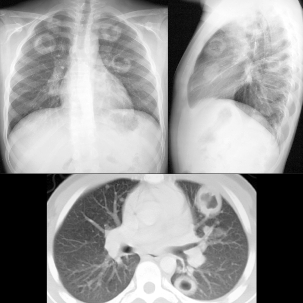Teenager with cough, fever and shortness of breath | Pediatric ...