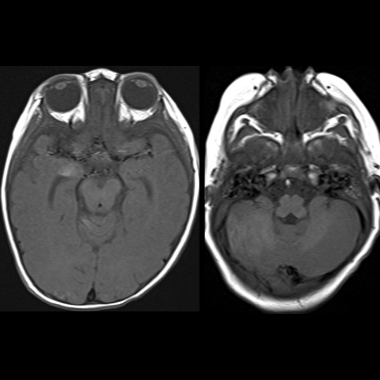 Pediatric Neurocutaneous Melanosis | Pediatric Radiology Reference ...