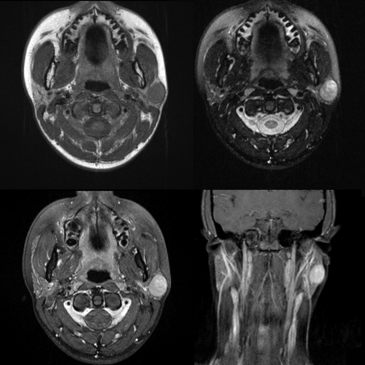 Teenager with a left cheek mass | Pediatric Radiology Case | Pediatric ...