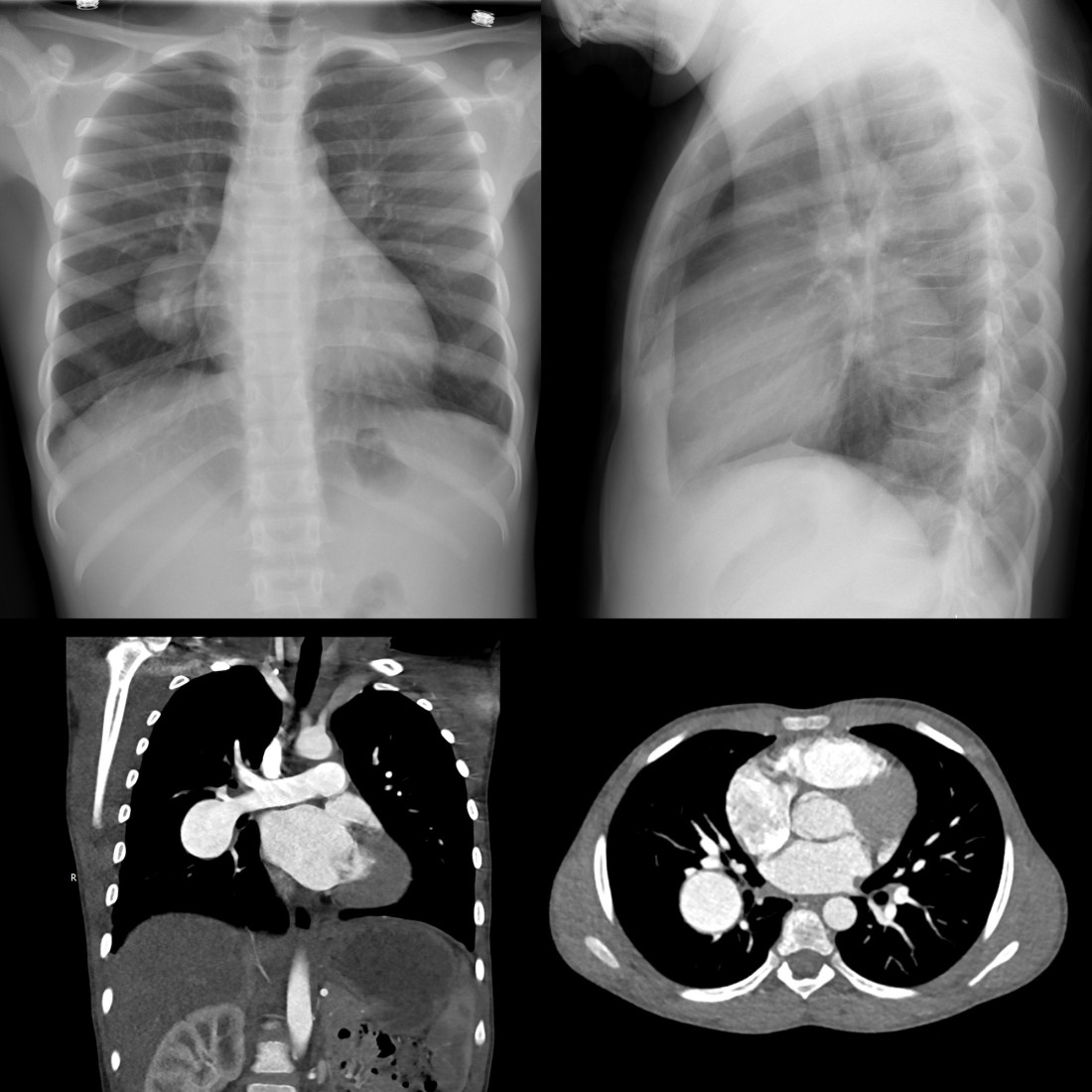 Pediatric Pulmonary Arterial Aneurysm | Pediatric Radiology Reference ...