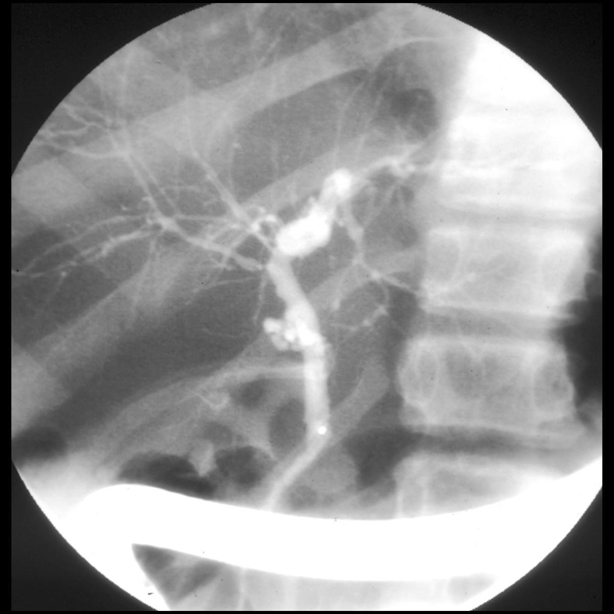 Teenager with jaundice and ulcerative colitis | Pediatric Radiology ...