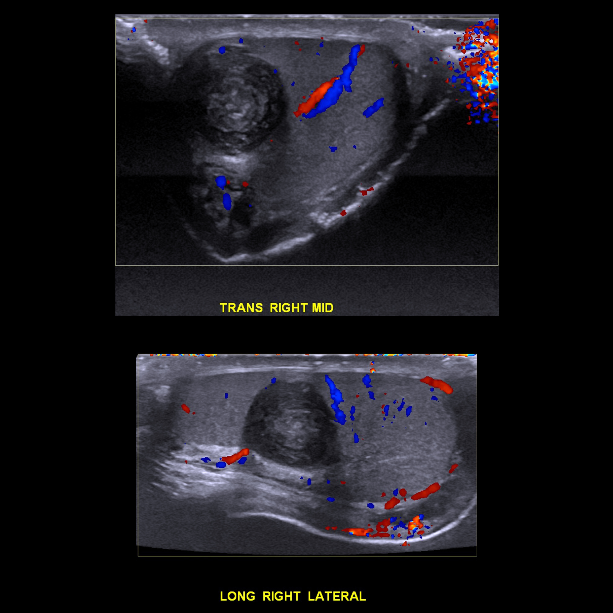 Pediatric Testicular Epidermoid Cyst | Pediatric Radiology Reference ...