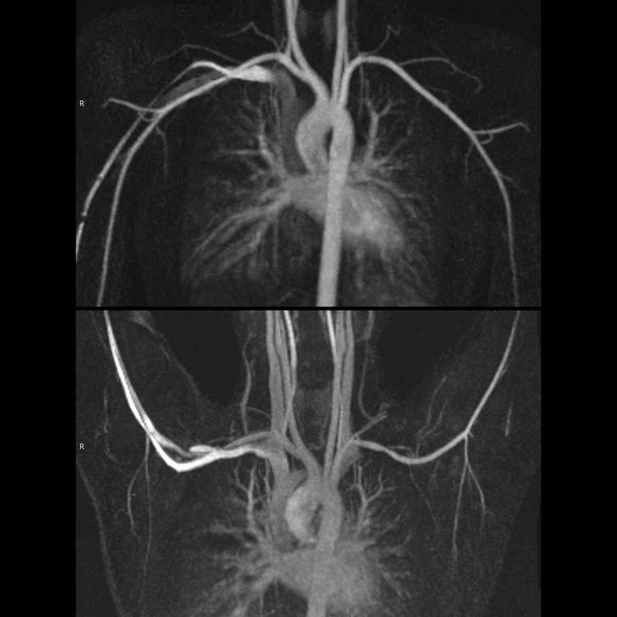 Teenager with weaker pulses in the left arm when compared to the right ...
