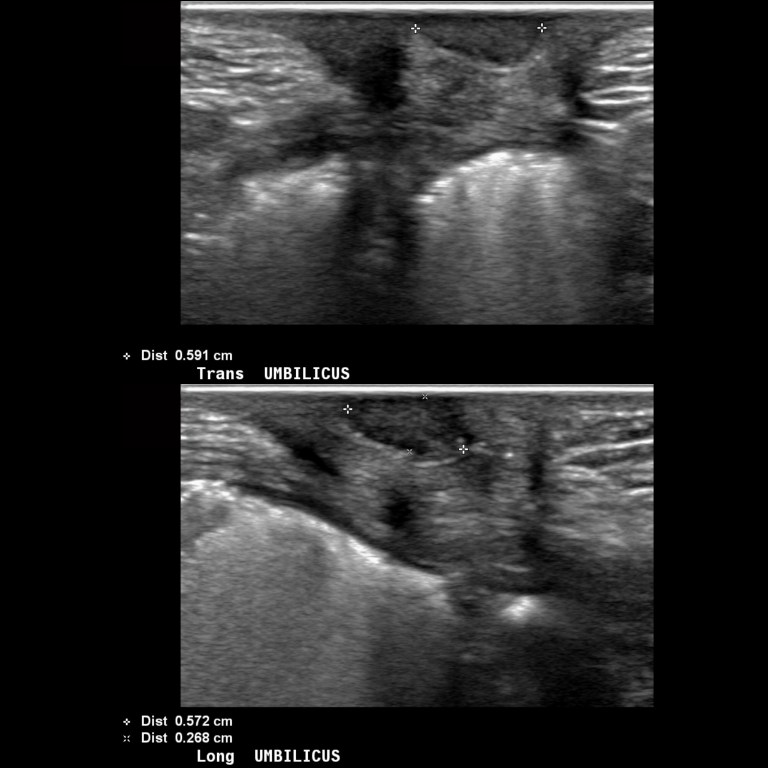 Pediatric Umbilical Granuloma | Pediatric Radiology Reference Article ...