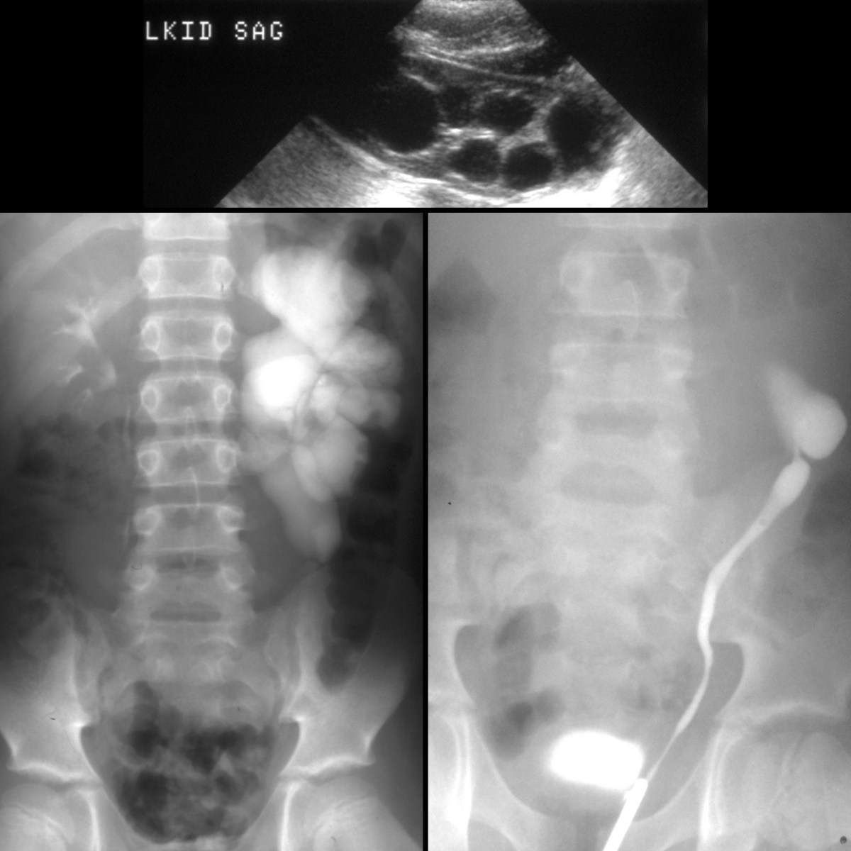 School ager with chronic left flank pain | Pediatric Radiology Case ...