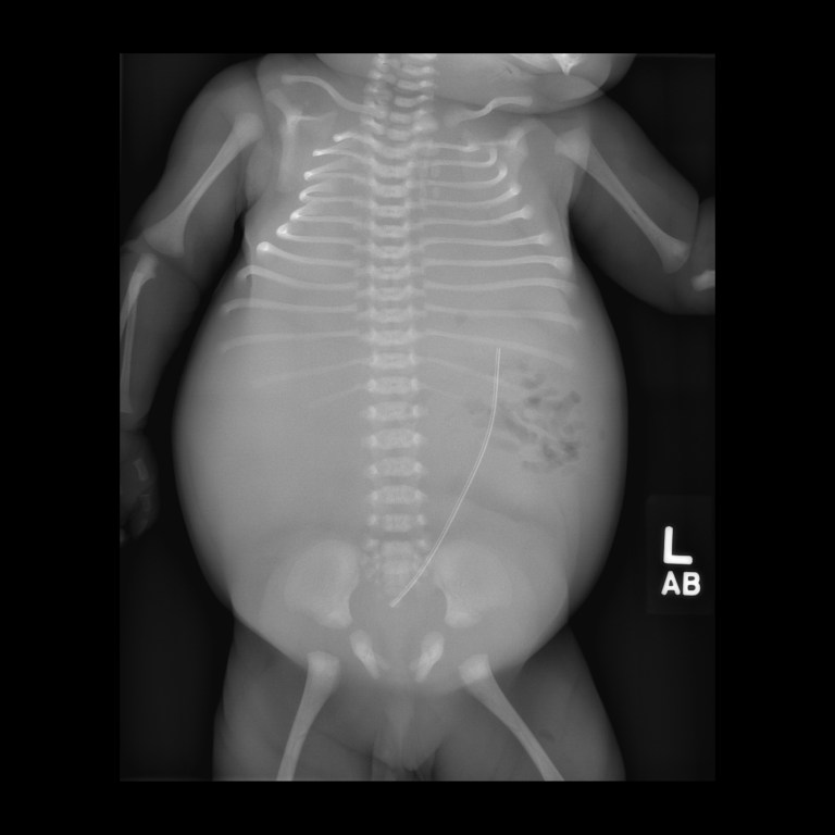 Newborn with oligohydramnios on prenatal US and bilateral large ...