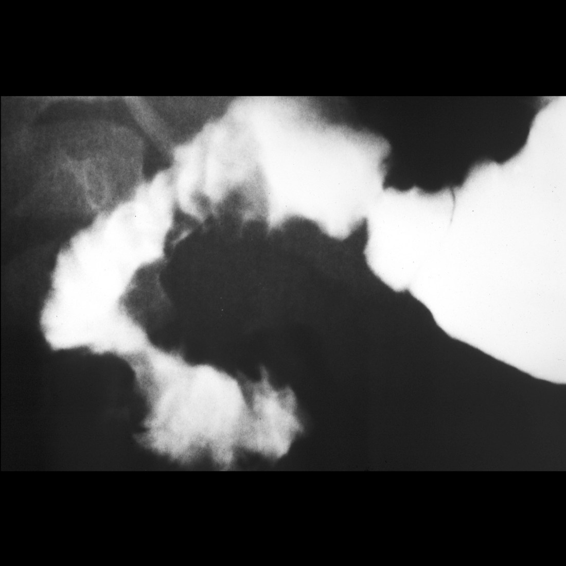 Gastric Antral Web | Pediatric Radiology Reference Article | Pediatric ...