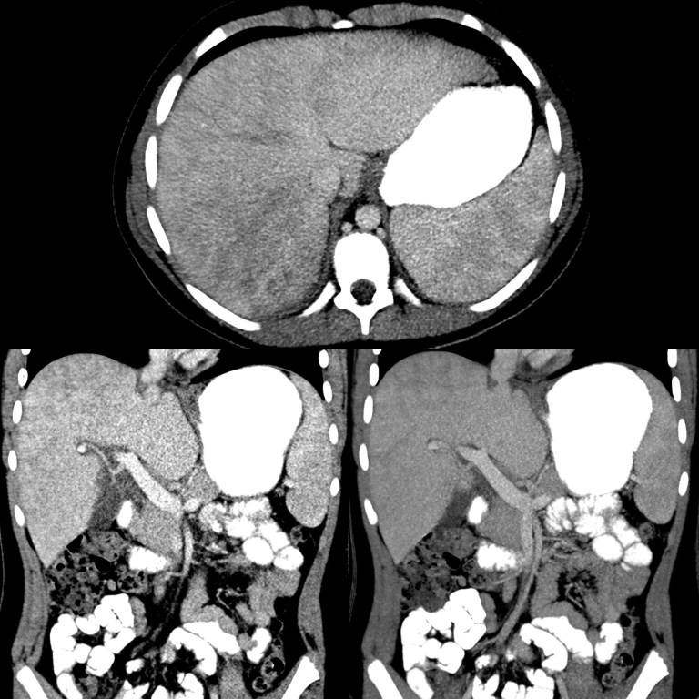 Pediatric Budd-Chiari Syndrome | Pediatric Radiology Reference Article ...