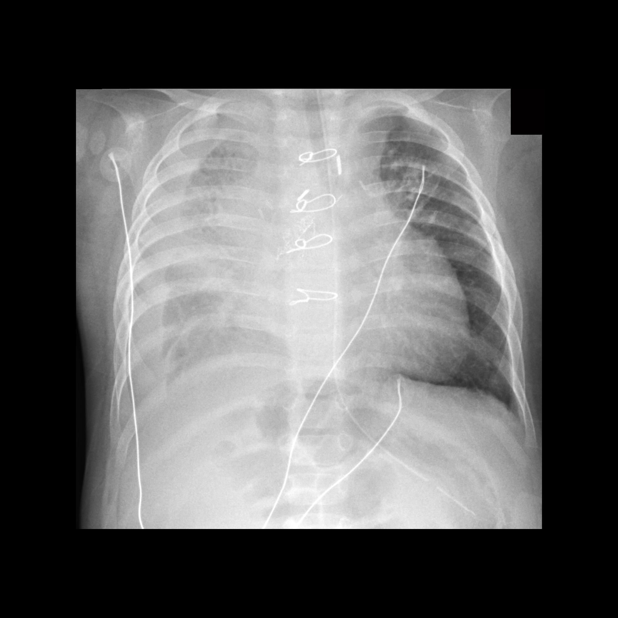 Pediatric Chylothorax | Pediatric Radiology Reference Article ...