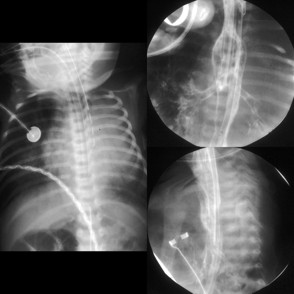 Newborn with respiratory distress | Pediatric Radiology Case ...