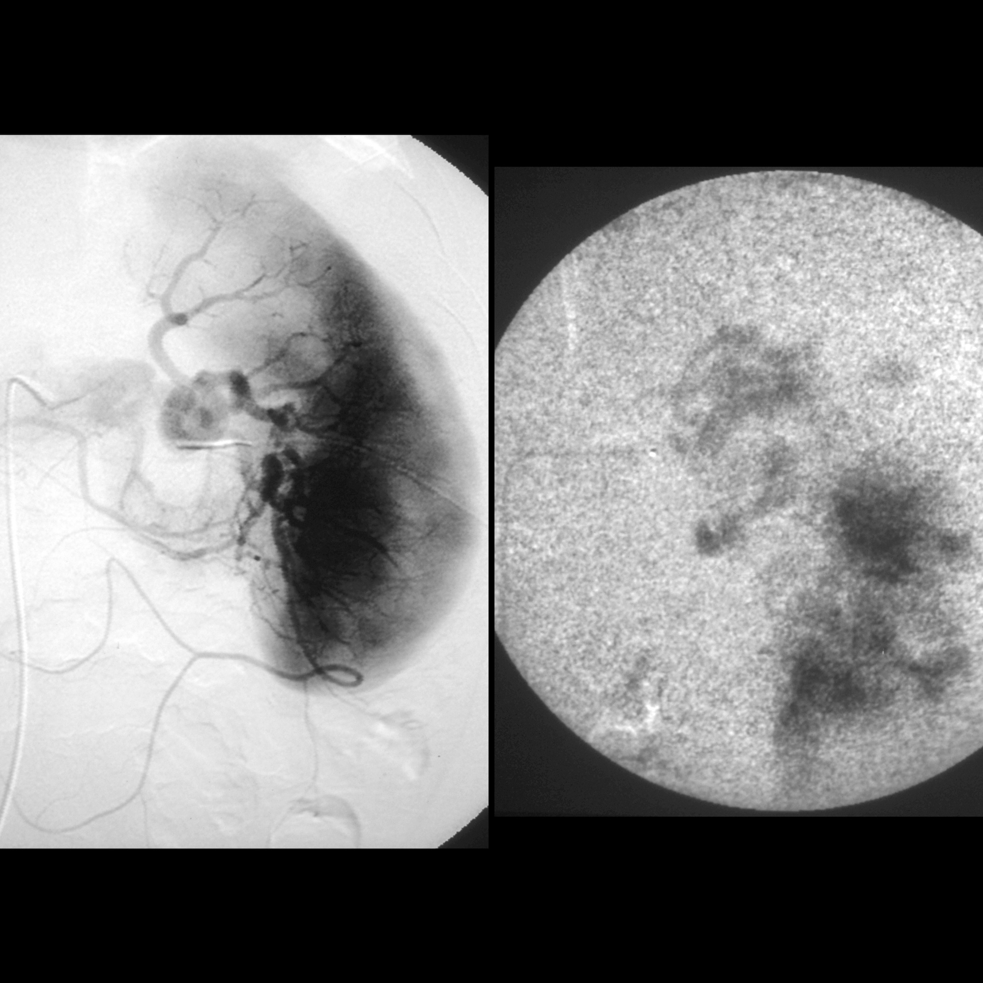 Pediatric Splenomegaly | Pediatric Radiology Reference Article ...