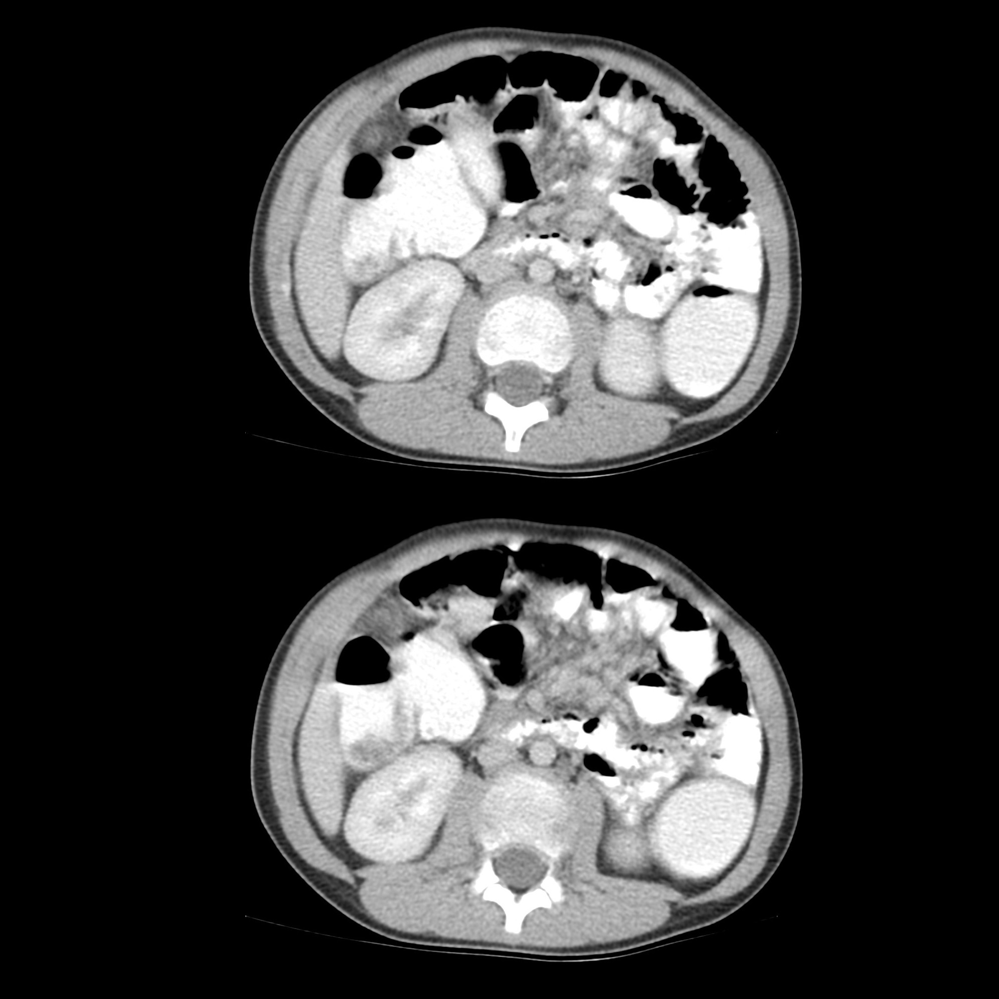 Pediatric Omental Torsion | Pediatric Radiology Reference Article ...