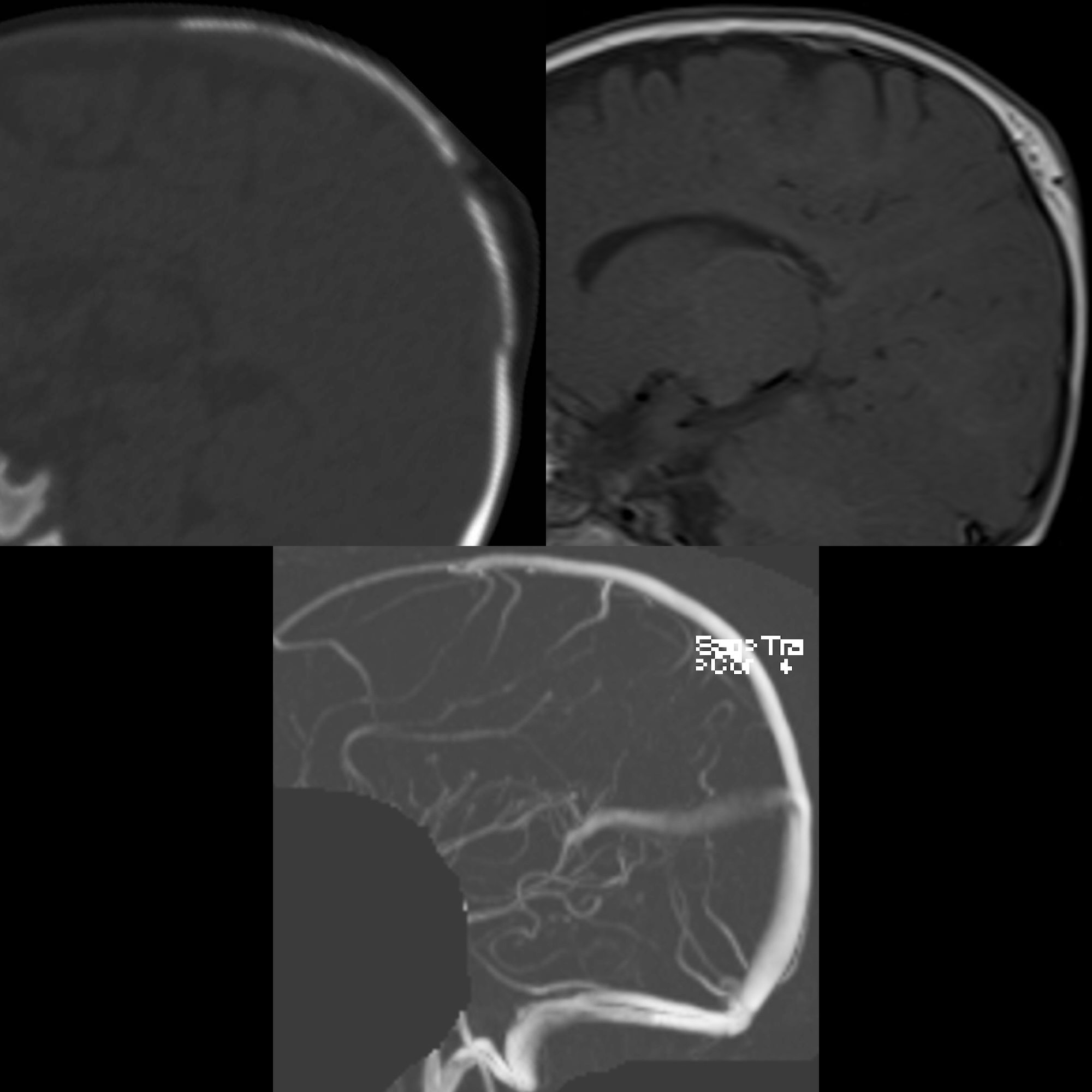Pediatric Sinus Pericranii | Pediatric Radiology Reference Article ...
