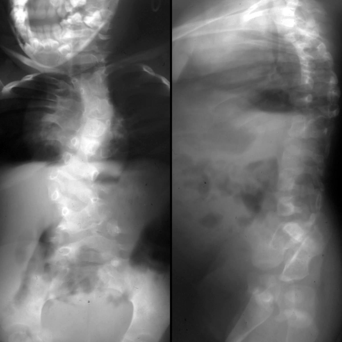 Toddler with short stature | Pediatric Radiology Case | Pediatric ...