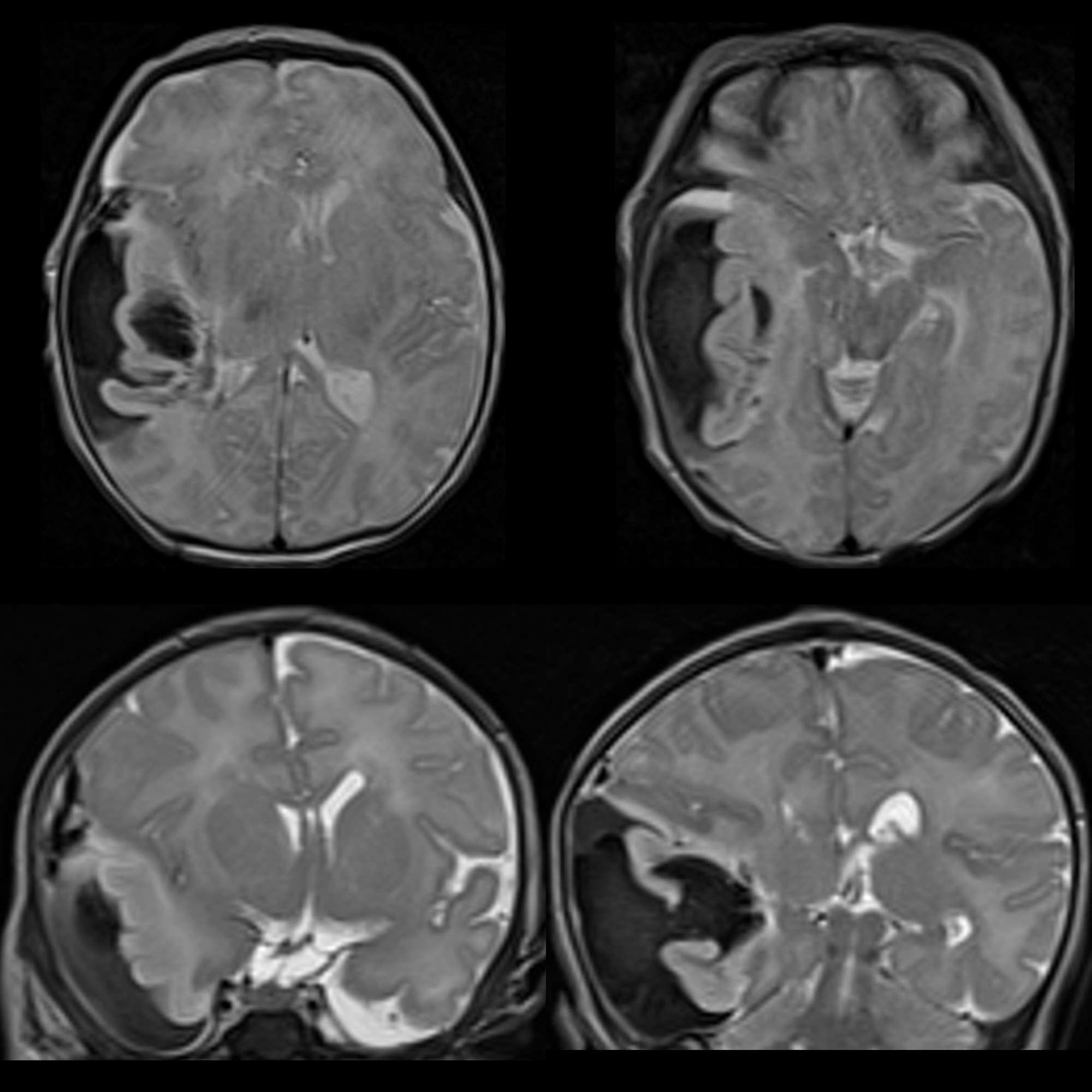 Pediatric Subpial Hemorrhage | Pediatric Radiology Reference Article ...