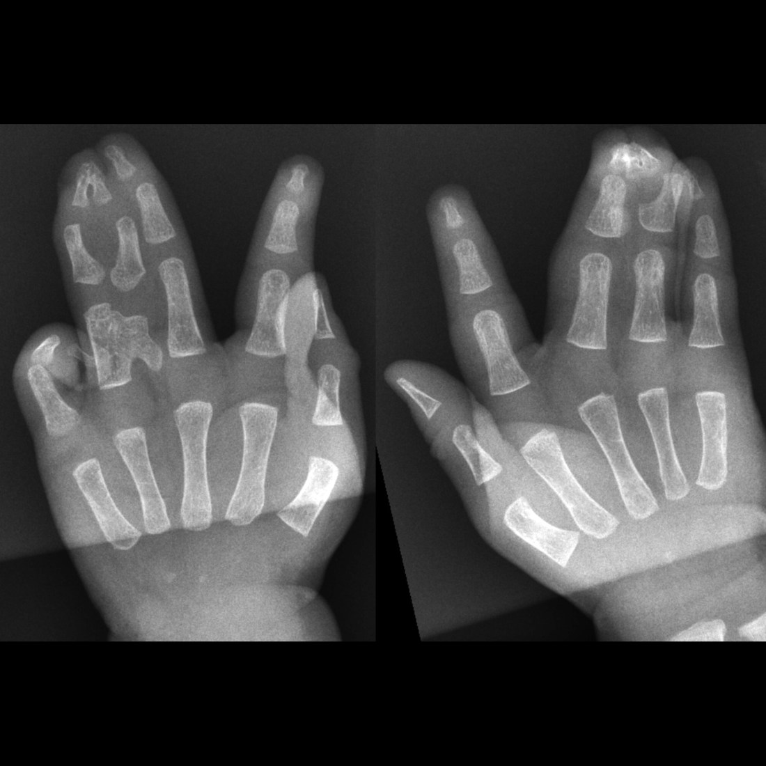 Pediatric Polydactyly | Pediatric Radiology Reference Article ...