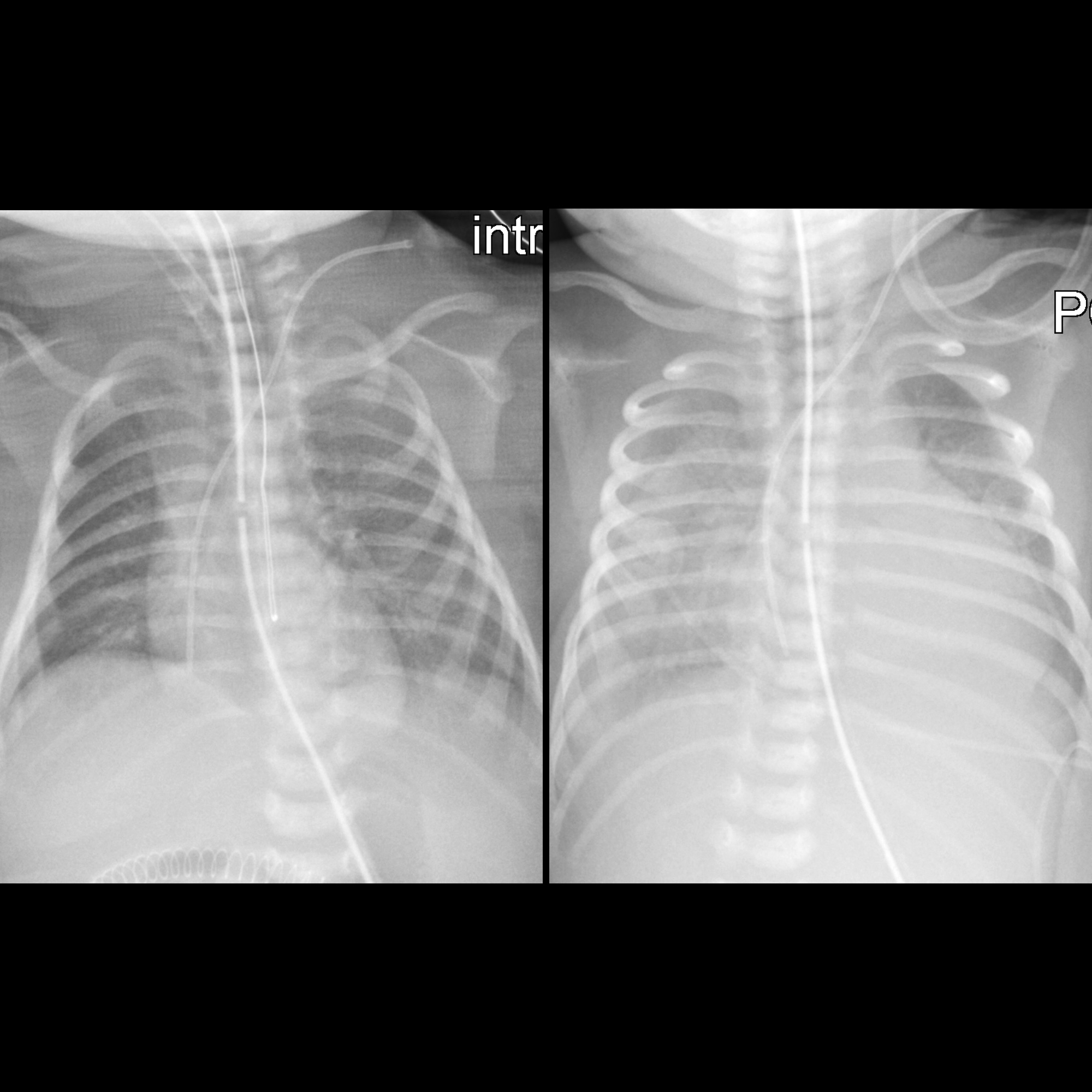 Pediatric Subclavian and Femoral Venous Catheter Malfunction ...