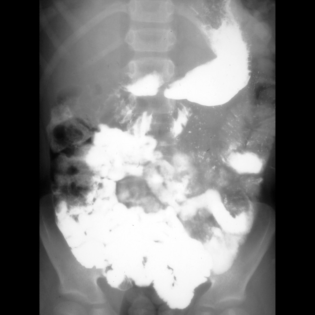 Pediatric Giardiasis | Pediatric Radiology Reference Article ...