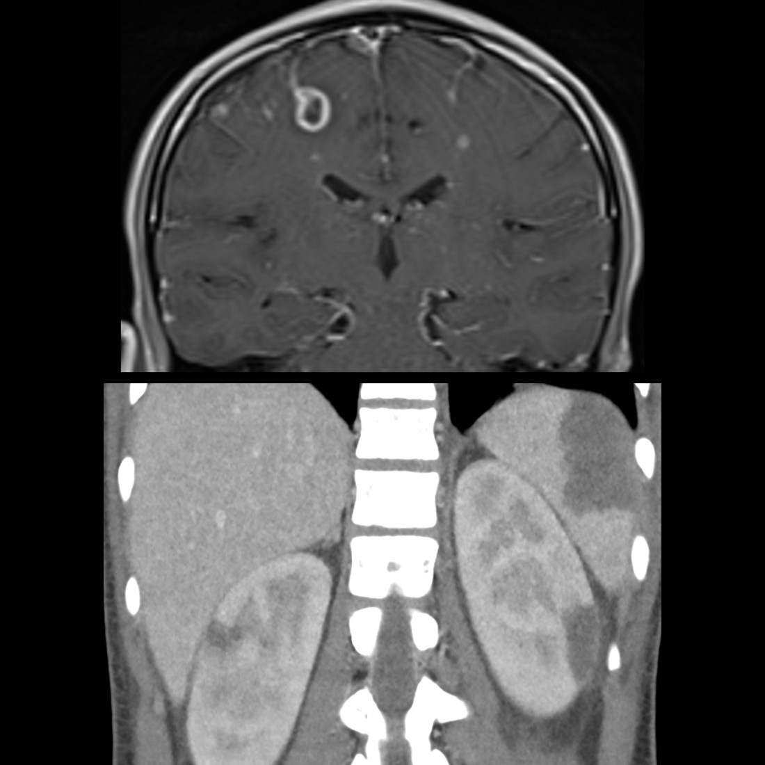 Pediatric Cerebritis and Pediatric Cerebral Abscess | Pediatric ...