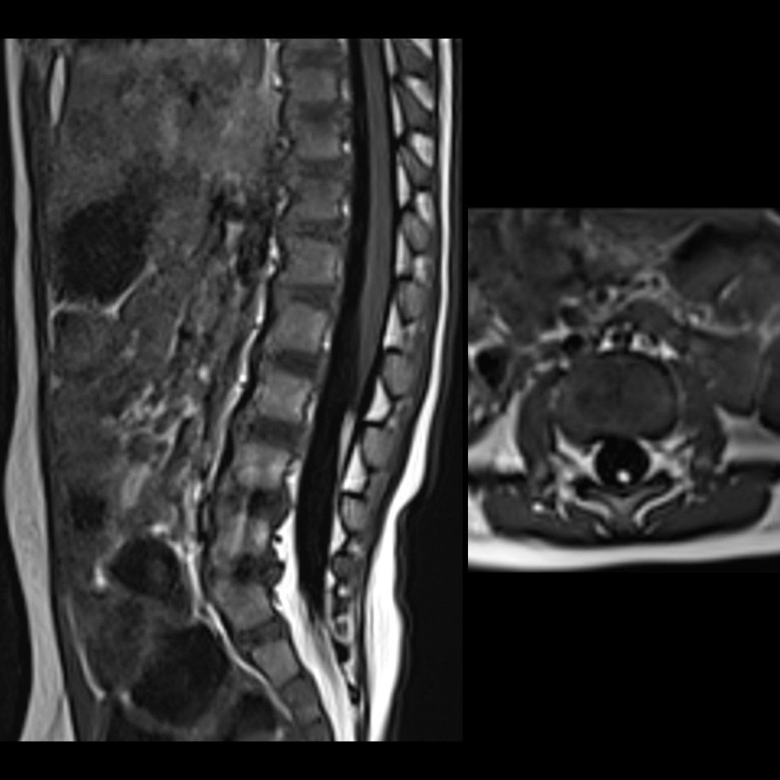 Filum Terminale Mri Tumors Of The Conus And Cauda Equina: Practice