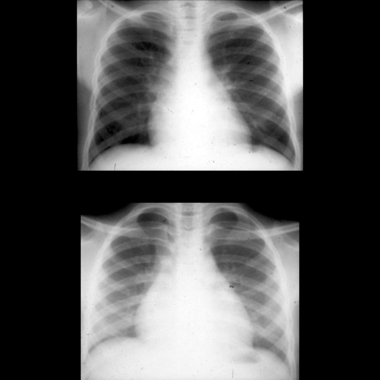 Pediatric Normal Chest | Pediatric Radiology Reference Article ...