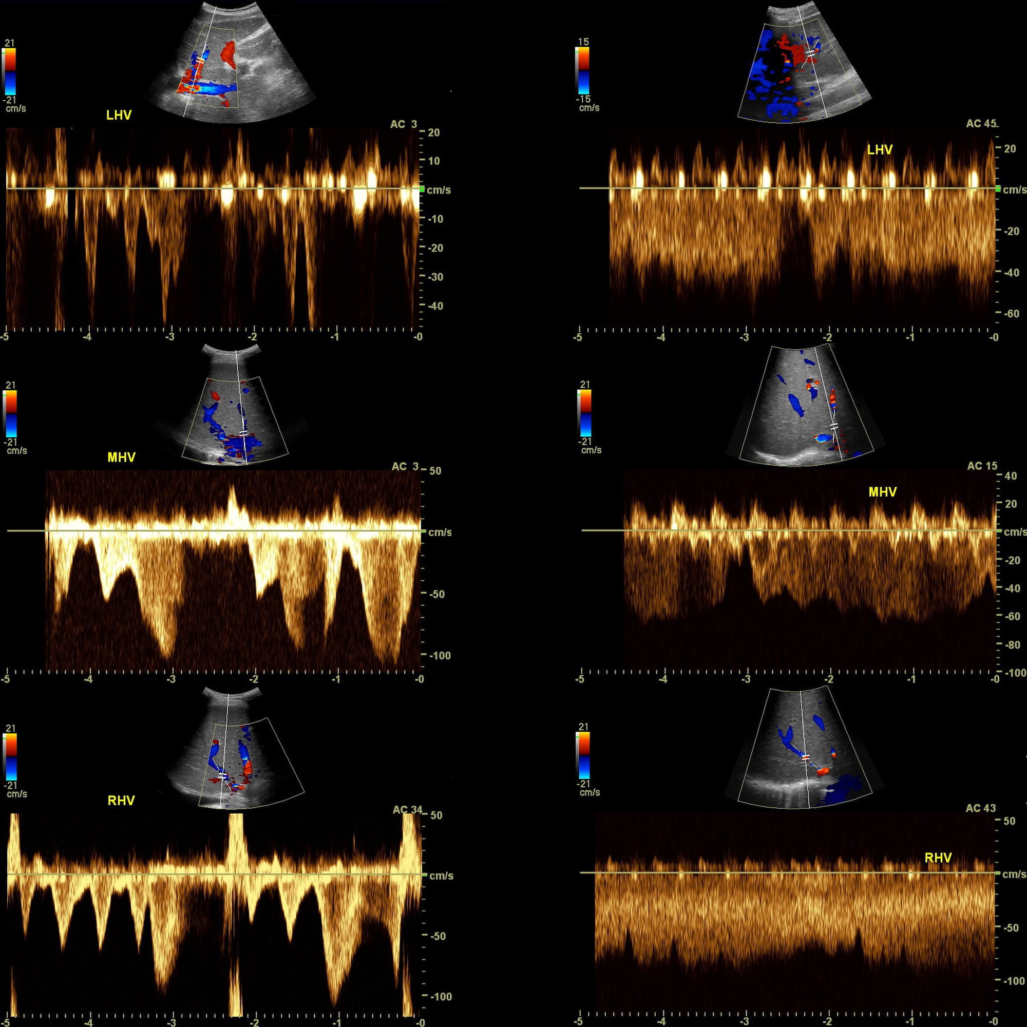 Pediatric Sinusoidal Obstruction Syndrome | Pediatric Radiology ...