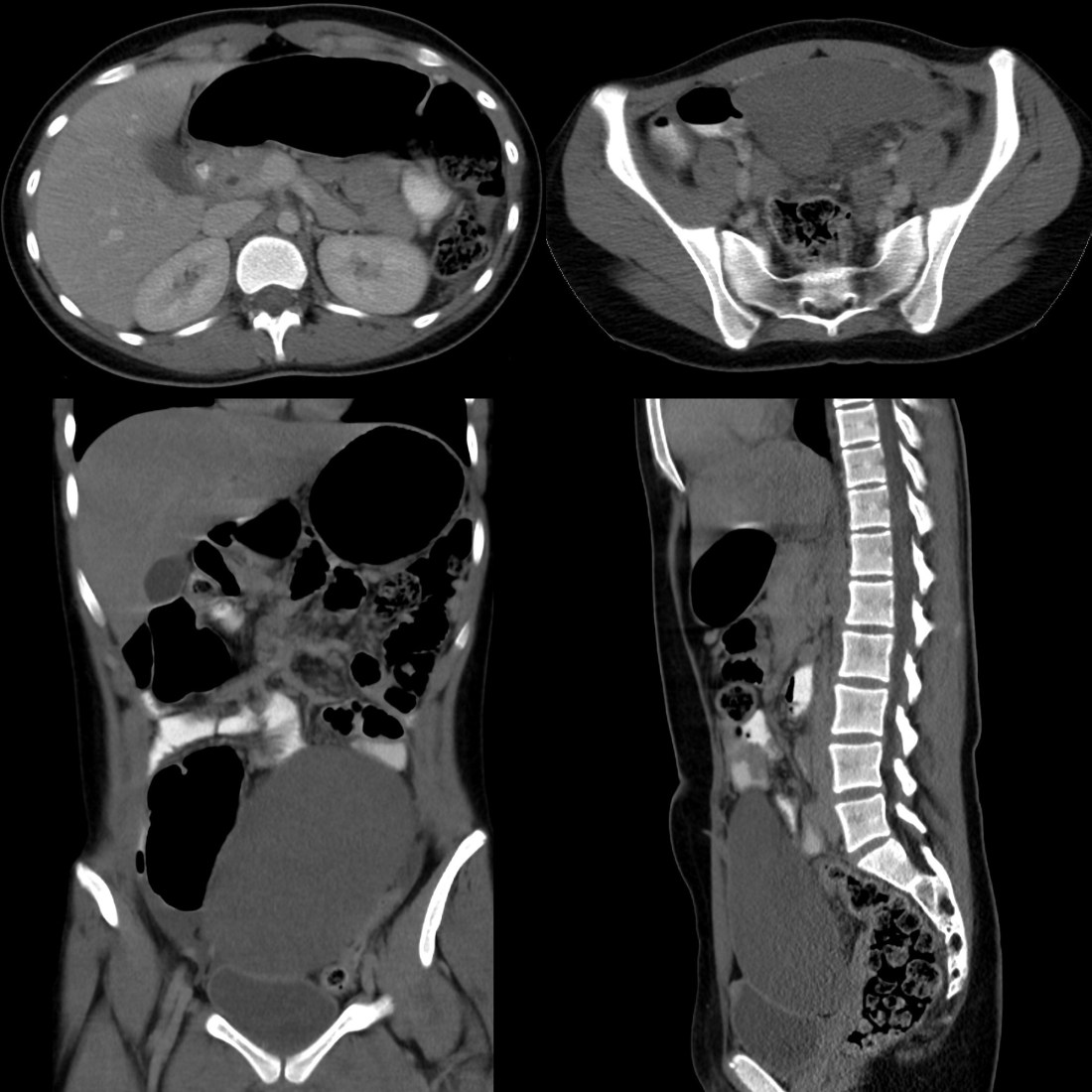 Pediatric Splenic Volvulus | Pediatric Radiology Reference Article ...