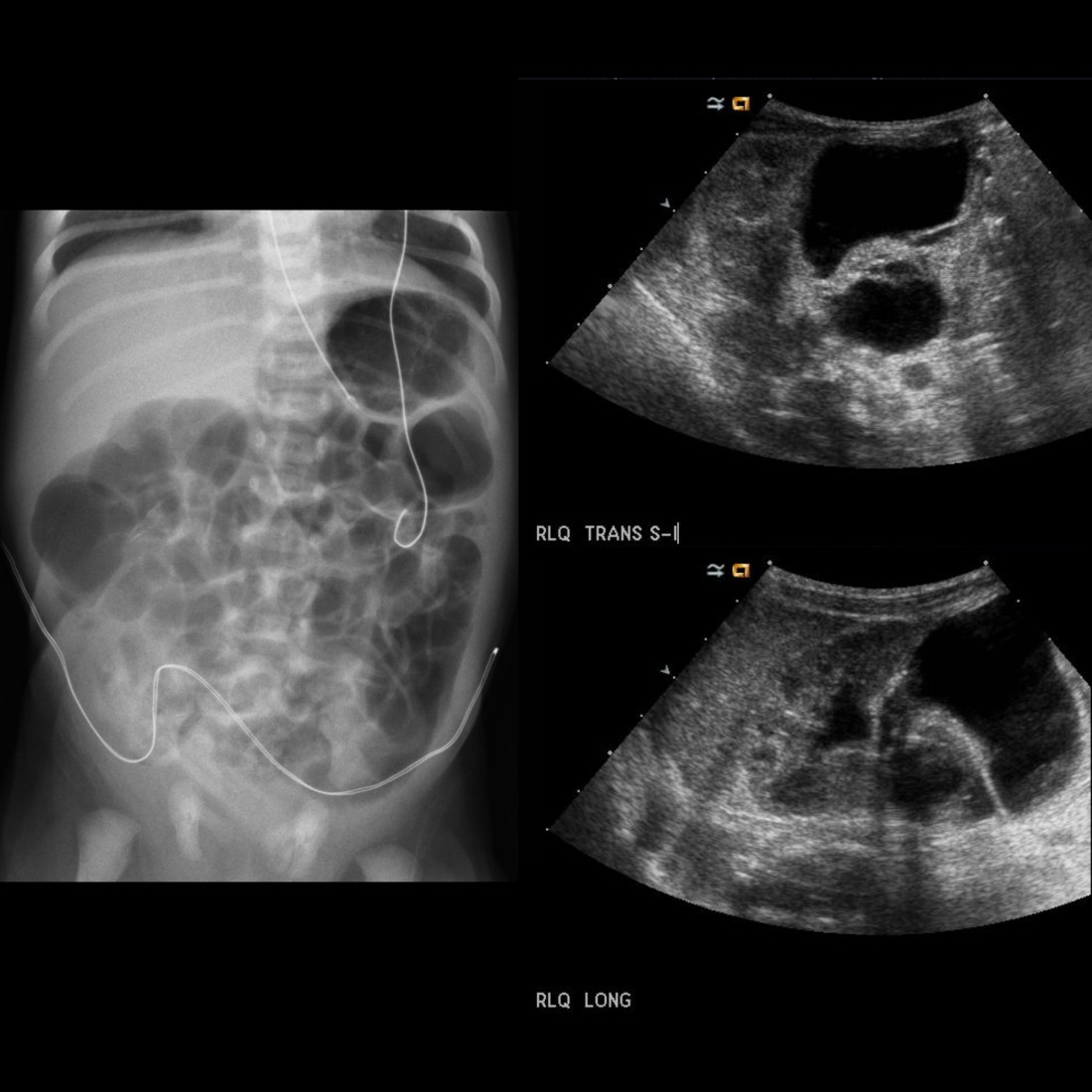 Pediatric Retroperitoneal Teratoma | Pediatric Radiology Reference ...
