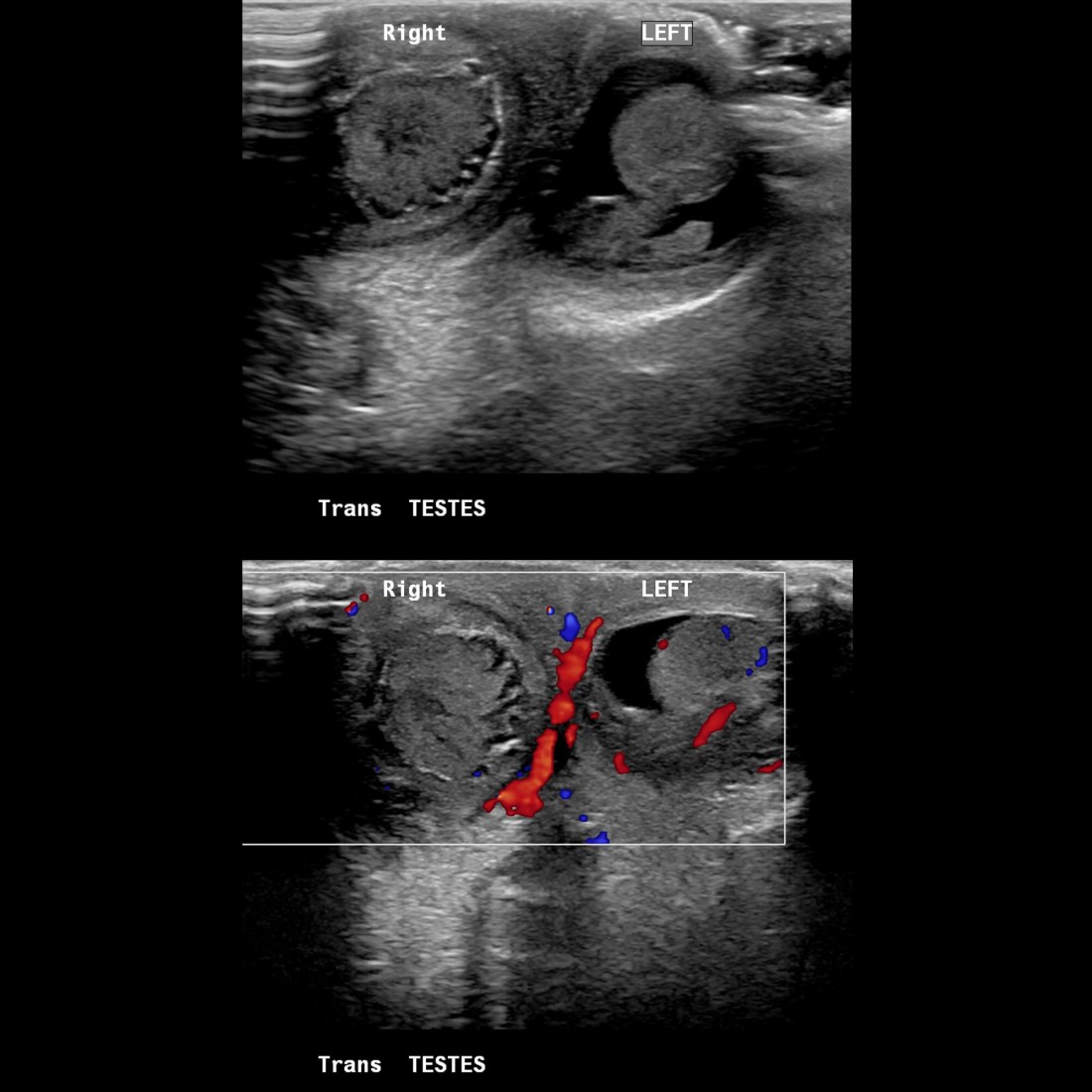 Newborn with a hard swollen right scrotum | Pediatric Radiology Case ...